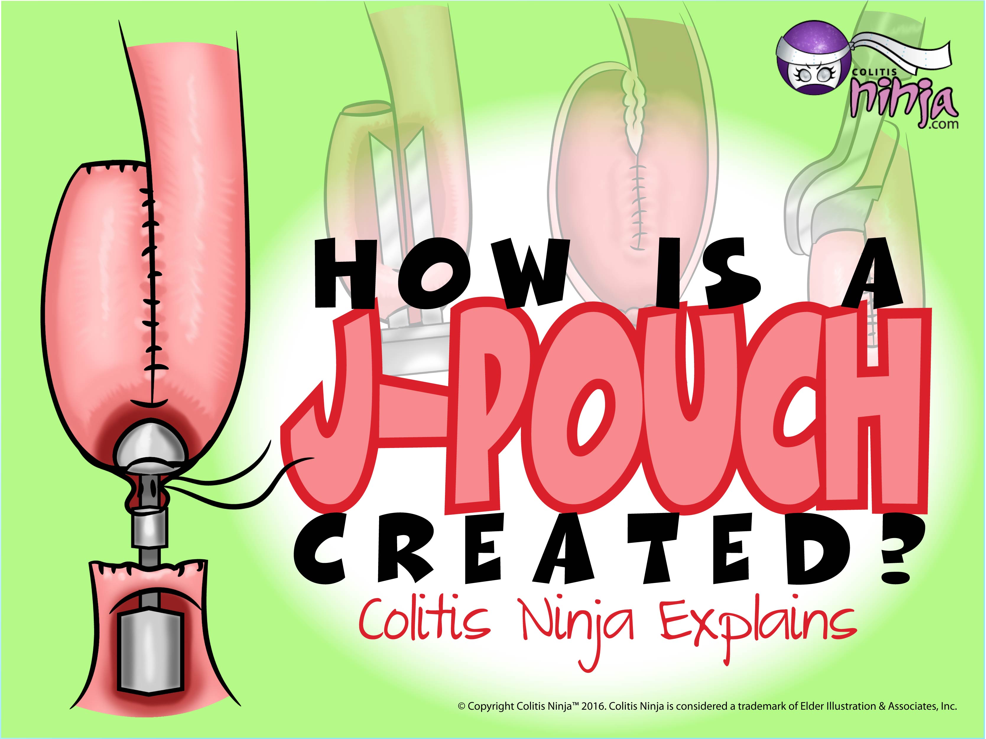 How Is A J Pouch Constructed Colitis Ninja How Is A J Pouch Constructed Colitis Ninja